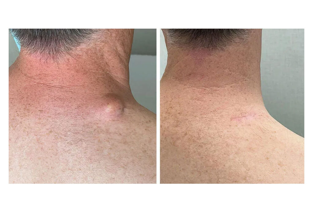 Divina Dermatology & Cosmetics | Beverly Hills | Cyst Removal